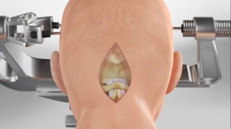 Mastering Arteriovenous Malformation Surgery: A Comprehensive Guide ...